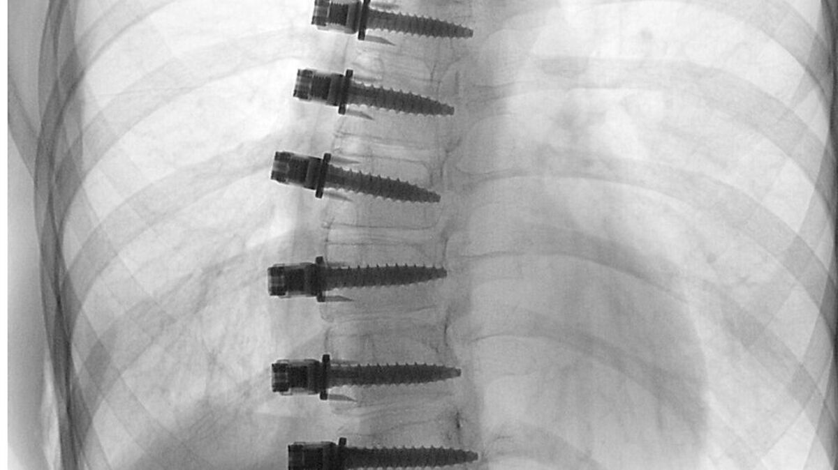 Skoliose: Neue Methode: Mit Seilen und Schrauben die Wirbelsäule aufrichten